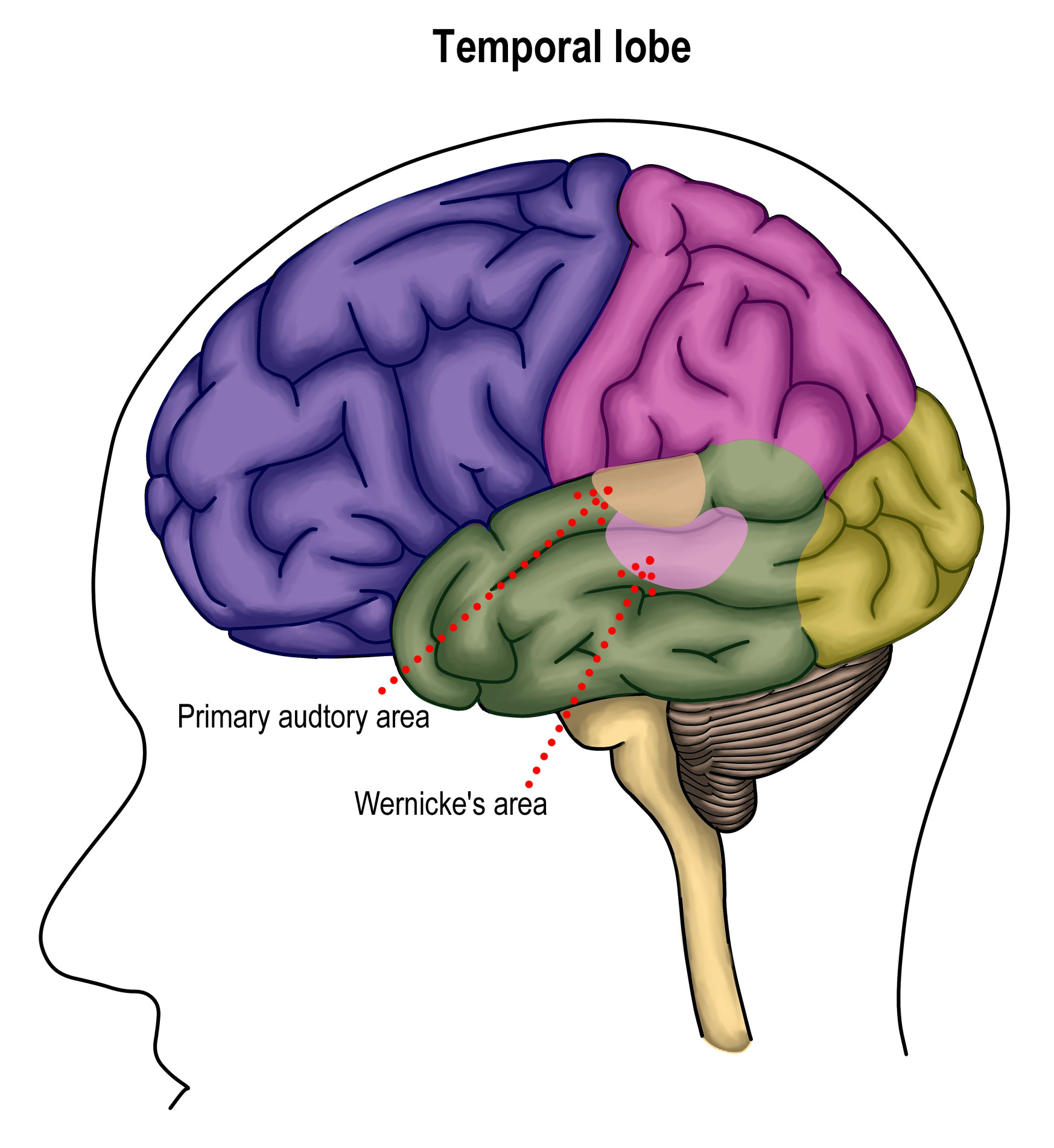 Sensory Aphasia Wernicke At Demetria Erickson Blog